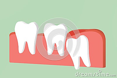 Wisdom Tooth Angular Or Mesial Impaction With Inflammation Affect To ...