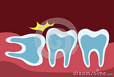 Wisdom Tooth Pushing Adjacent Teeth, Wisdom Tooth Problem. Teeth Row ...