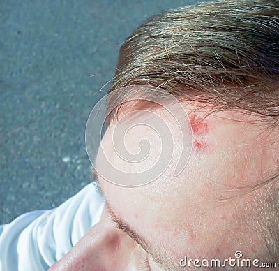 Wound On Forehead Royalty Free Stock Image - Image: 32028246