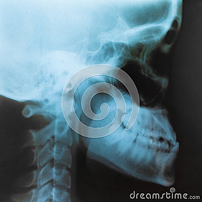 Xray/Face side stock image. Image of health, disease, diagnosis - 198831