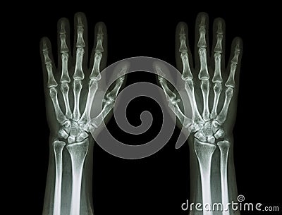 X-Ray Hands ( Front View ) : Normal Human Hands Royalty-Free Stock ...