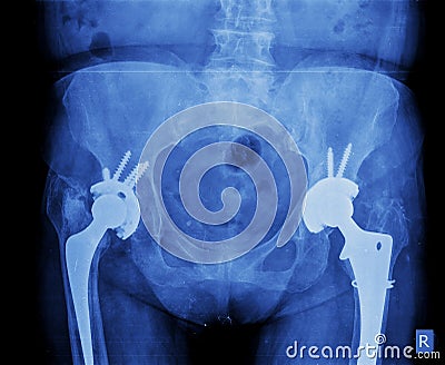 X-ray of hip prosthesis stock photo. Image of bone, pelvis - 47702704