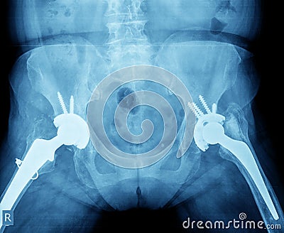 X-ray of hip prosthesis stock photo. Image of bone, pelvis - 47702704