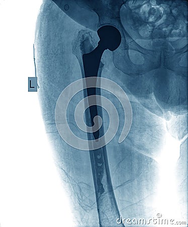 X-ray of hip prosthesis stock photo. Image of bone, pelvis - 47702704