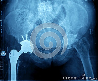 X-ray of hip prosthesis stock photo. Image of bone, pelvis - 47702704