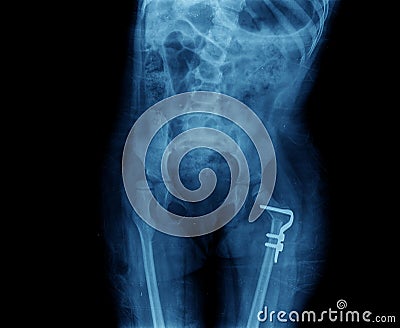 X-ray of hip prosthesis stock photo. Image of bone, pelvis - 47702704