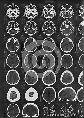 MRI Brain Scan or X-ray Neurology Human Head Skull Tomography Test ...