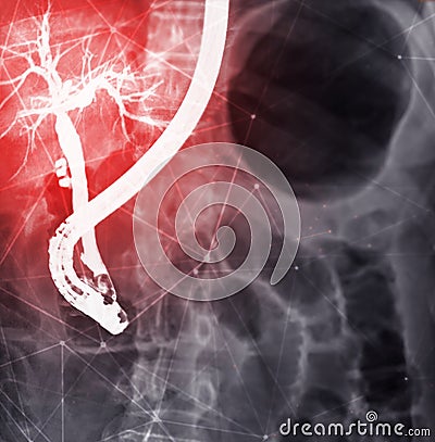 X-ray Image Of Endoscopic After Doctor Doing ERCP And Laparoscopic ...
