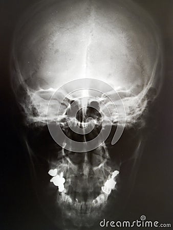 Xray/Face side stock image. Image of health, disease, diagnosis - 198831