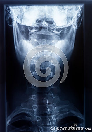 X-ray Of The Neck And Skull - Rear View Royalty-Free Stock Photo ...
