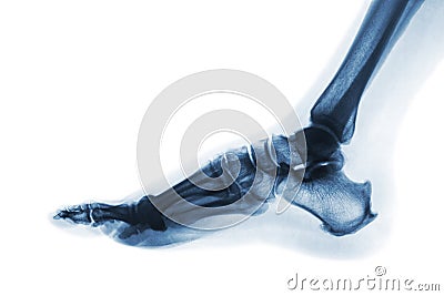 X-ray Normal Human Foot . Lateral View . Invert Color Style Royalty ...