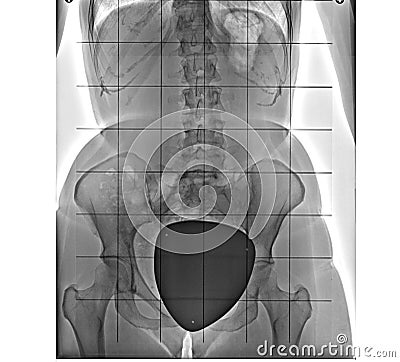 X-ray Of The Pelvis And Spinal Column, Front View Royalty-Free Stock ...