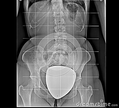 X-ray Of The Pelvis And Spinal Column, Front View Stock Photography ...