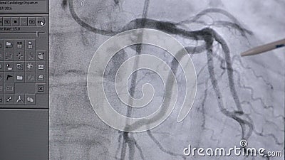 X-ray Real Heart Beating in Action. Stock Video - Video of medicine ...