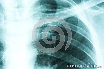X-Ray Of Ribs And Spine Stock Image | CartoonDealer.com #46349689