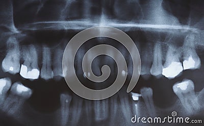 X-ray Scan Of Humans Teeth Royalty-Free Stock Image | CartoonDealer.com ...
