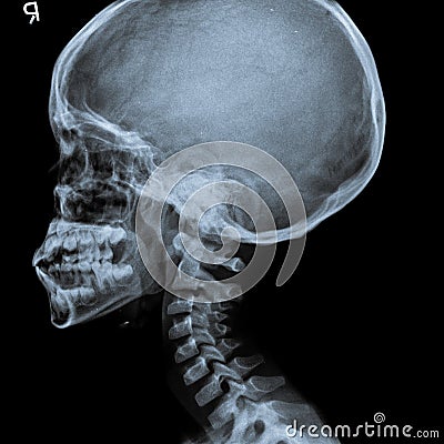 X Ray Of Side View Of Human Child Skull. Stock Photography ...
