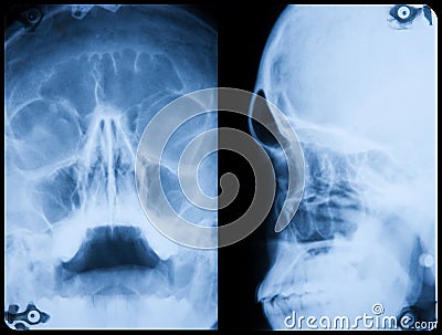 Xray/Face side stock image. Image of health, disease, diagnosis - 198831