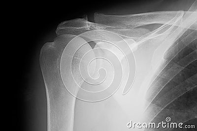 Xray Of Shoulder - Radiography Stock Photography - Image: 22481452