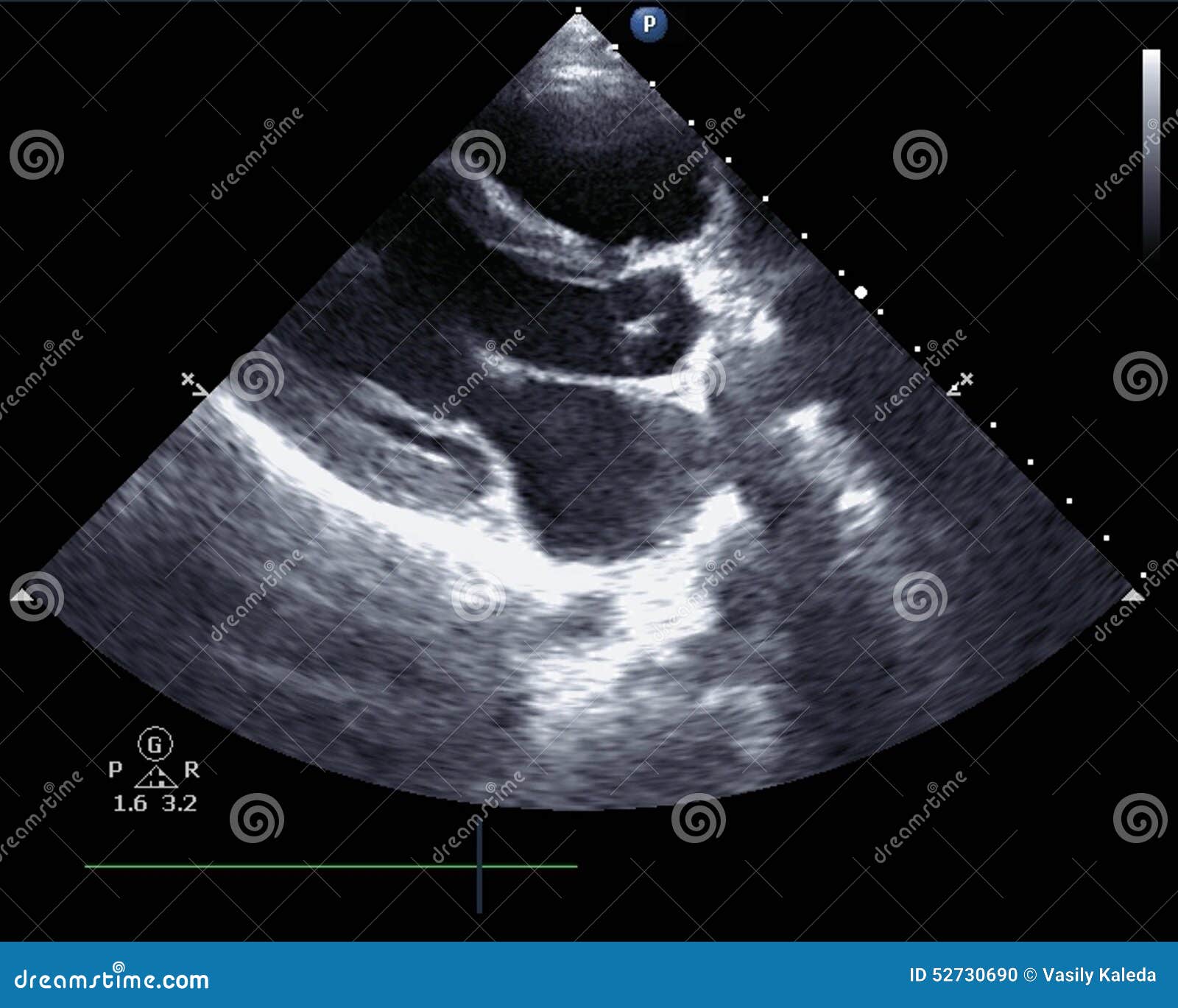 Échocardiogramme photo stock. Image du cardiologie, maladie - 52730690