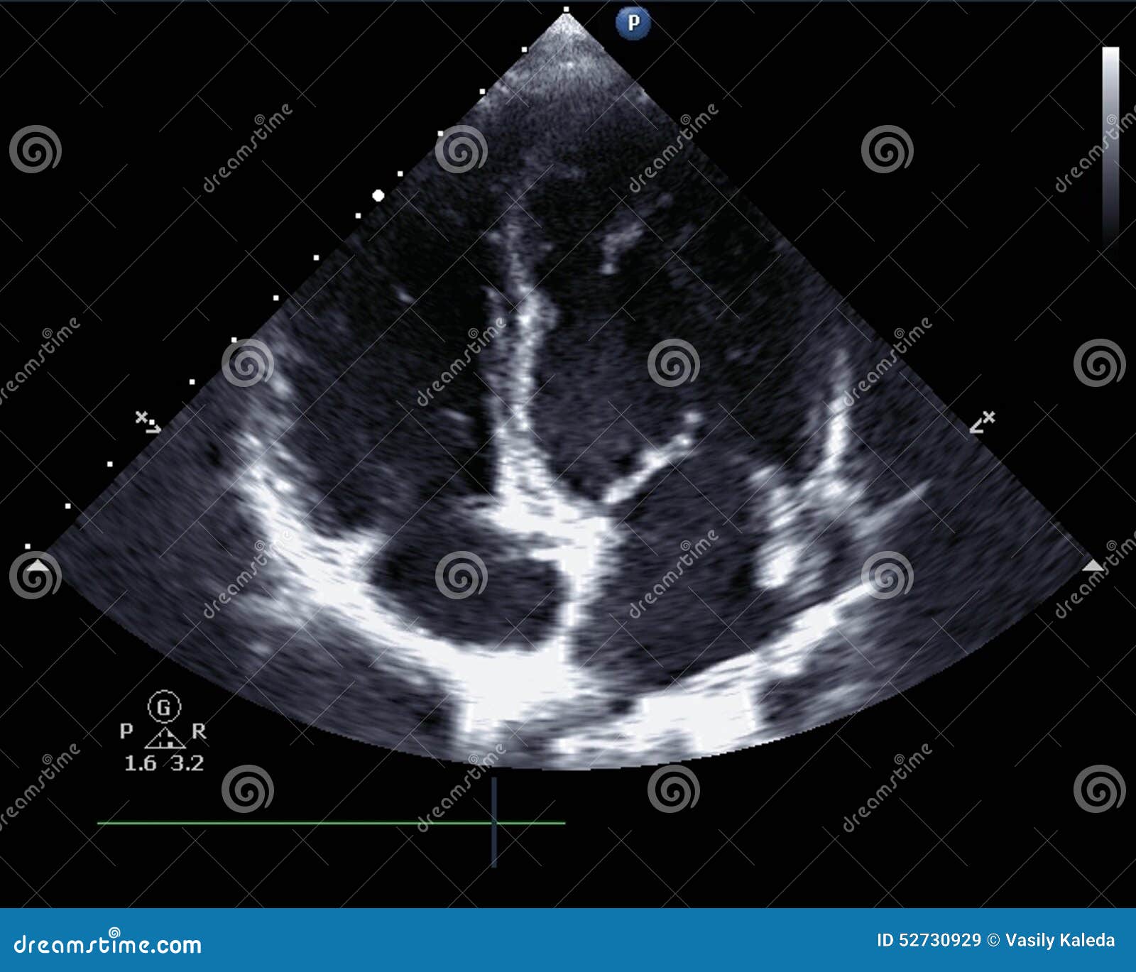 Échocardiogramme image stock. Image du gauche, segment - 52730929