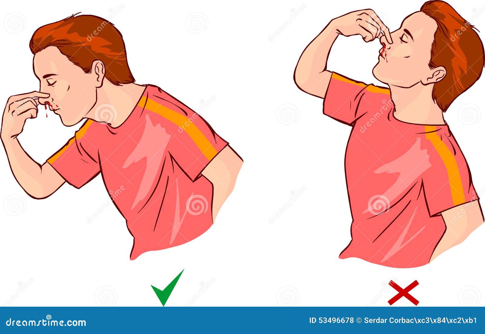 épistaxis illustration de vecteur. Illustration du baisse - 53496678