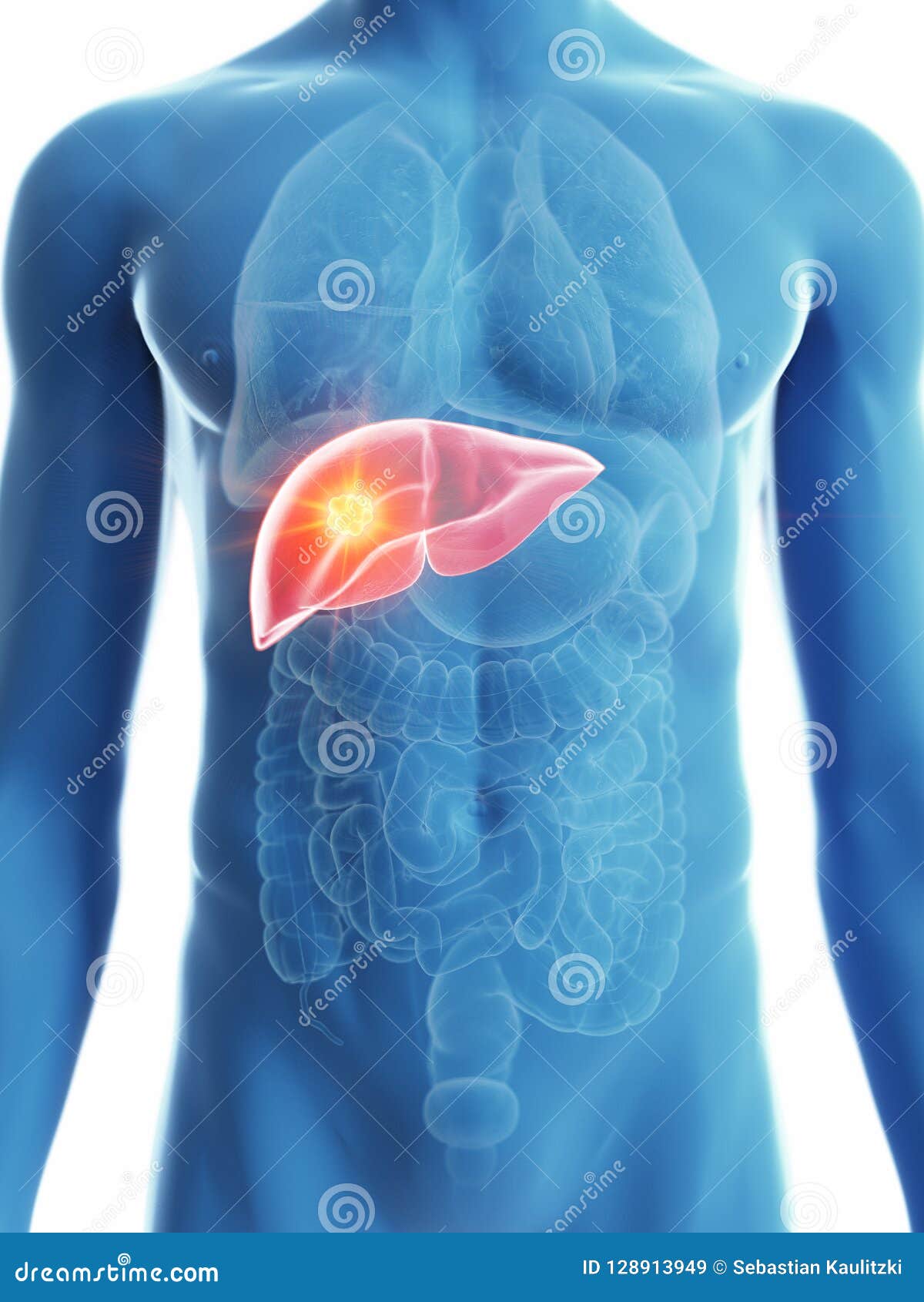 Équipe le cancer de foie illustration stock. Illustration du équipe ...