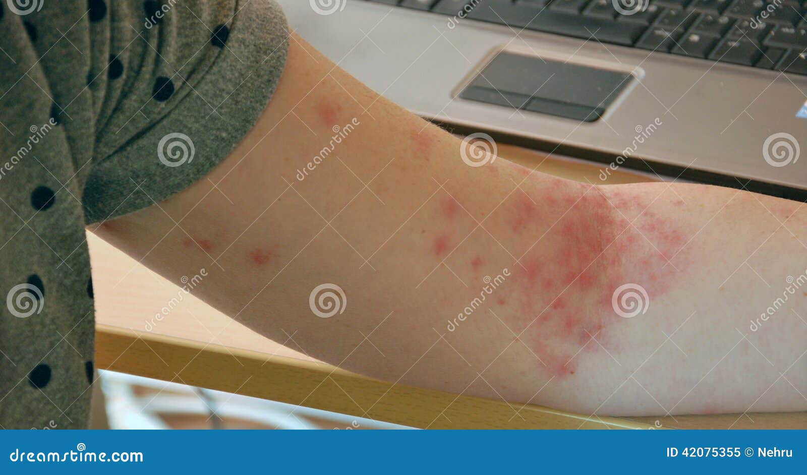 éruption cutanée image stock. Image du réaction, dermatologie - 42075355