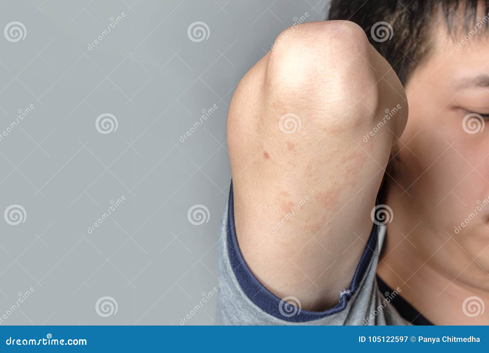 Éruption D'allergie Sur Le Bras Image stock - Image du irrité ...