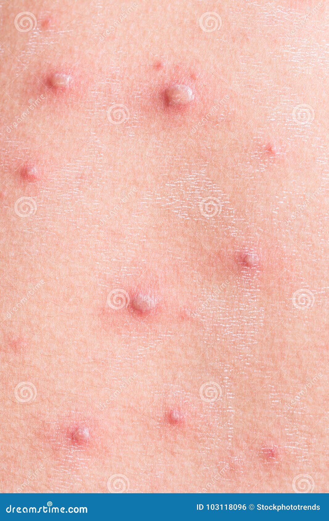 Éruption de varicelle photo stock. Image du moyen, aéroporté - 103118096