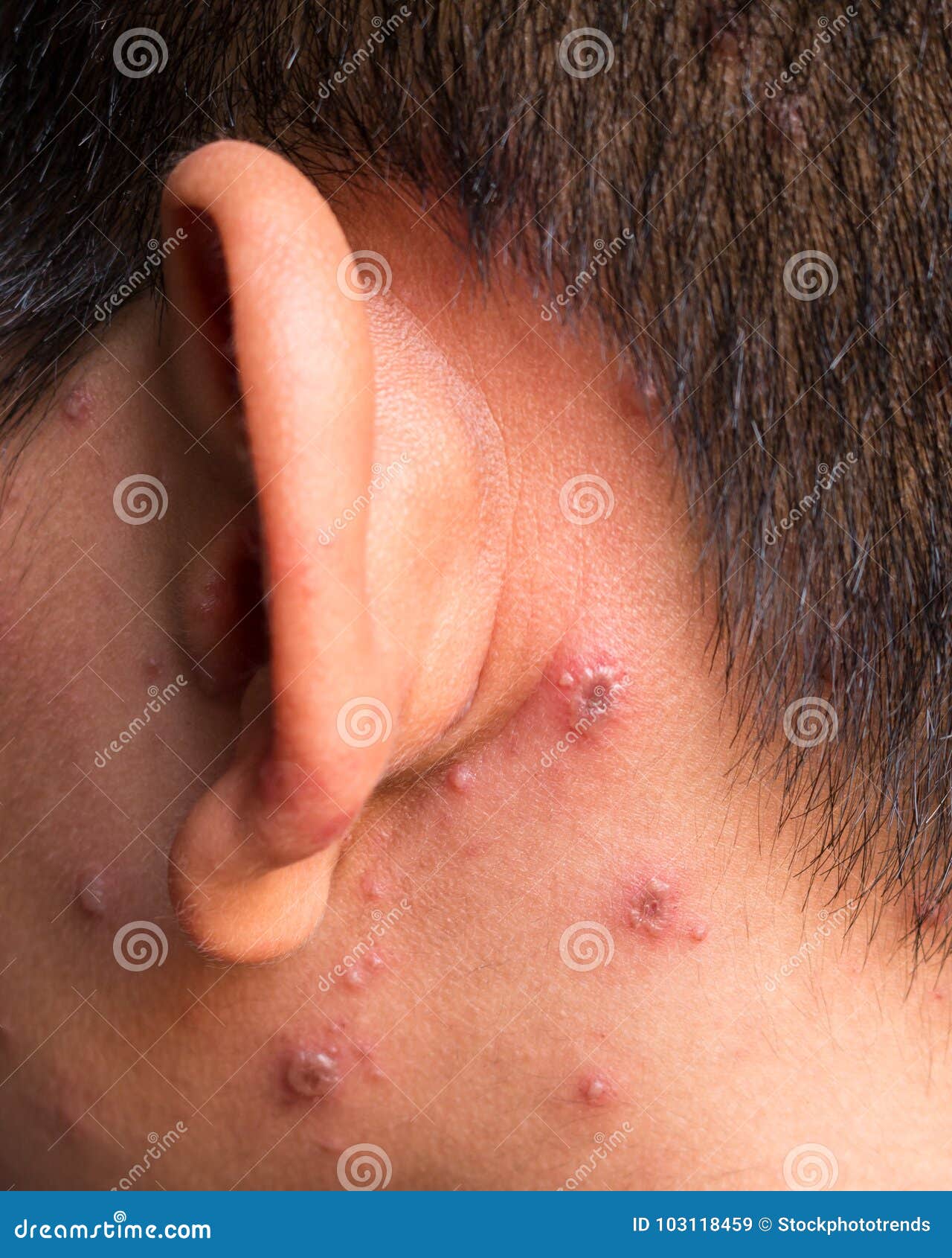 Éruption de varicelle image stock. Image du dépresseur - 103118459