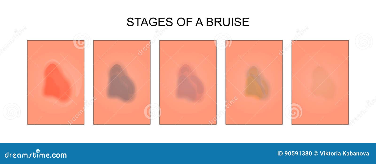 Étapes De La Guérison D'une Contusion Illustration de Vecteur ...