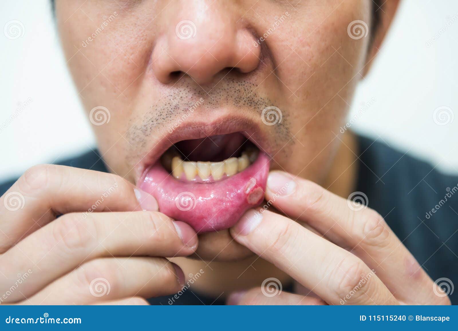 Úlcera Dolida Del Aphtha En La Boca Foto de archivo - Imagen de ampolla ...