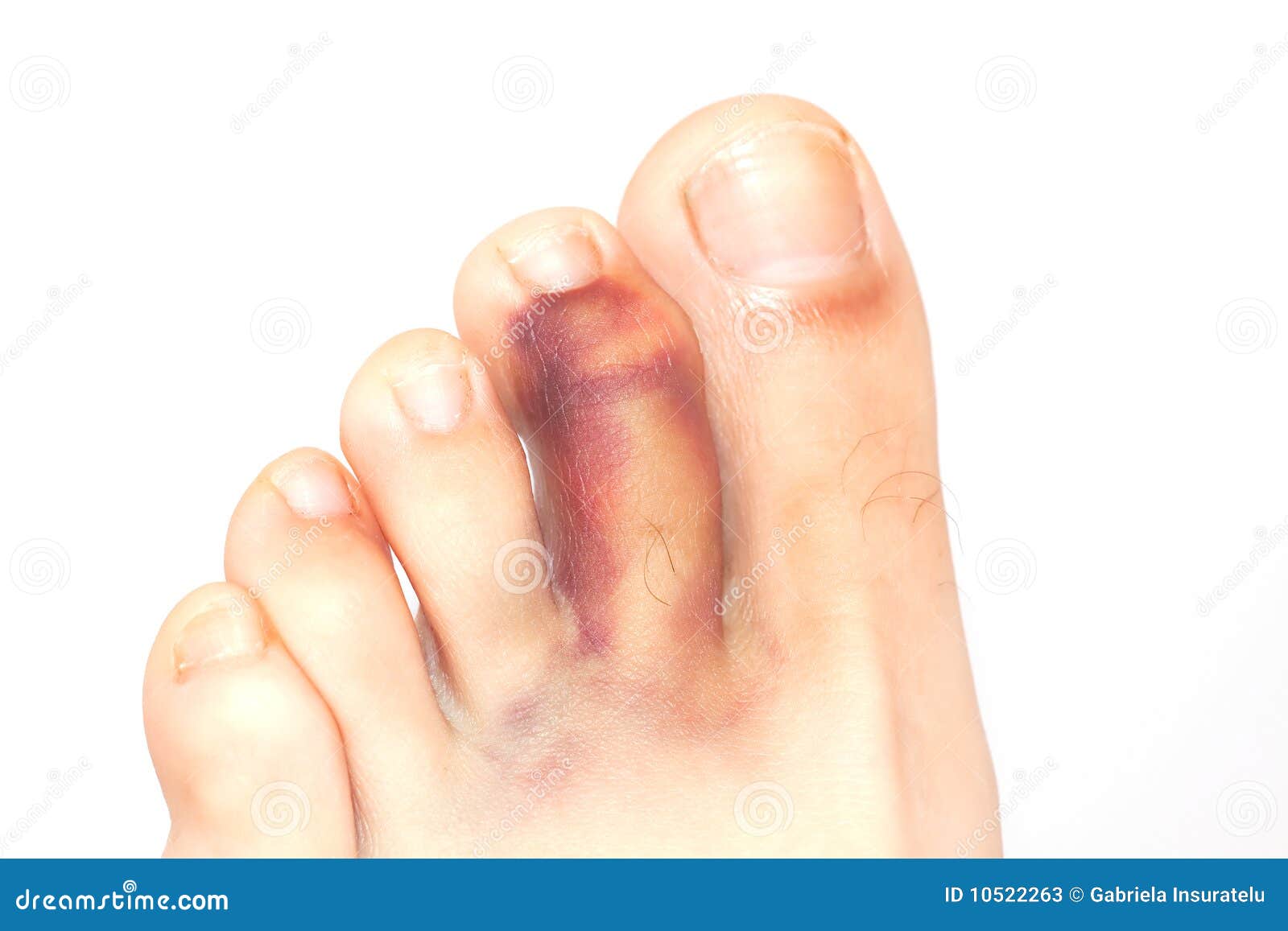 Foot Rot Disease In Humans at Kate Donaghy blog