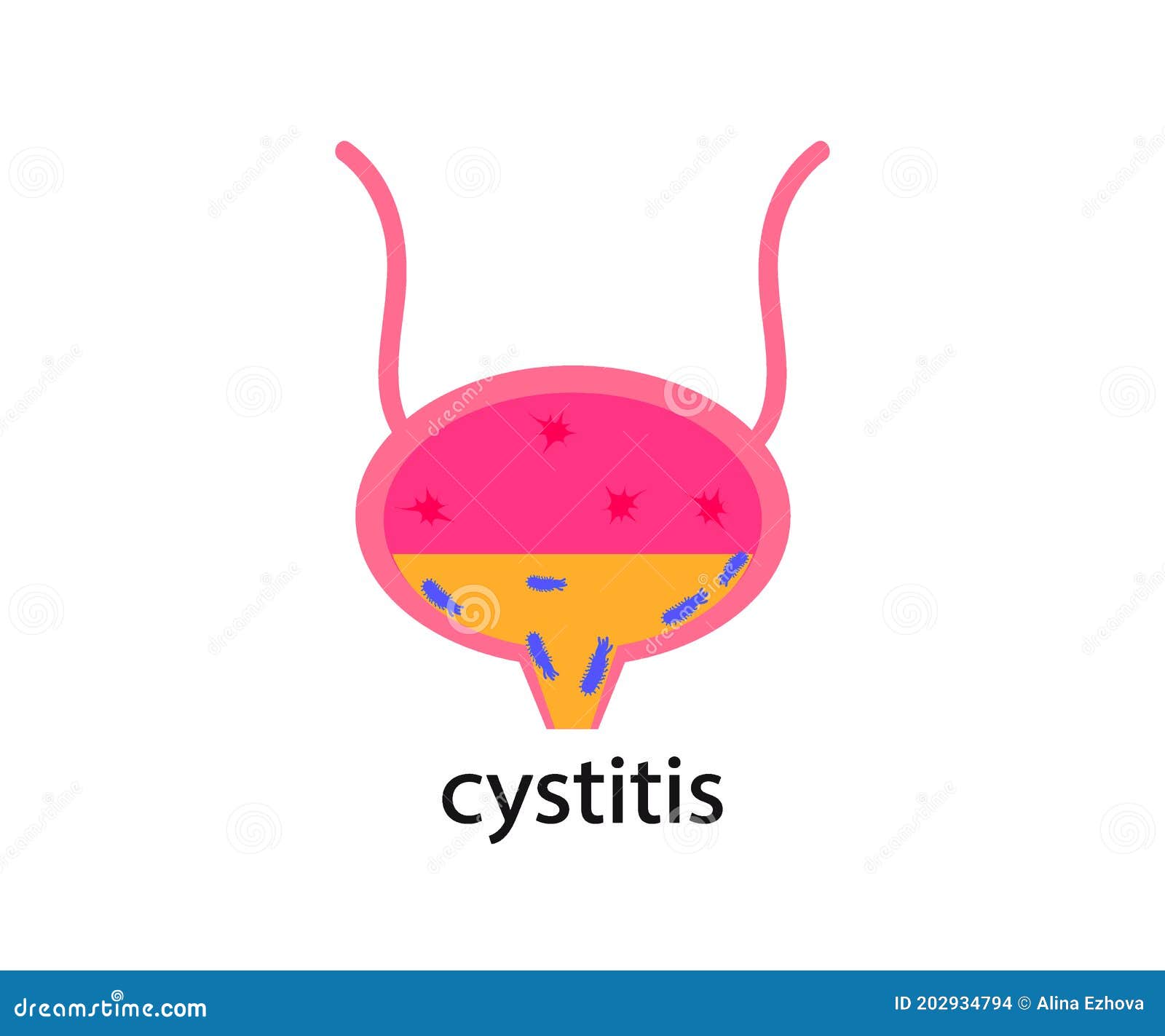 Bladder on a White Background. Cystitis. Vector Stock Vector ...