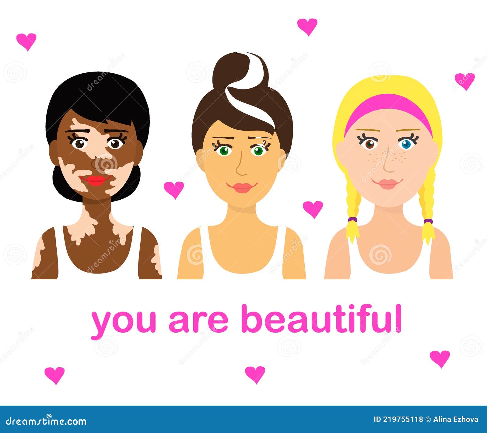 Various Pretty Girls with Vitiligo. Cartoon. Vector. Stock Vector ...