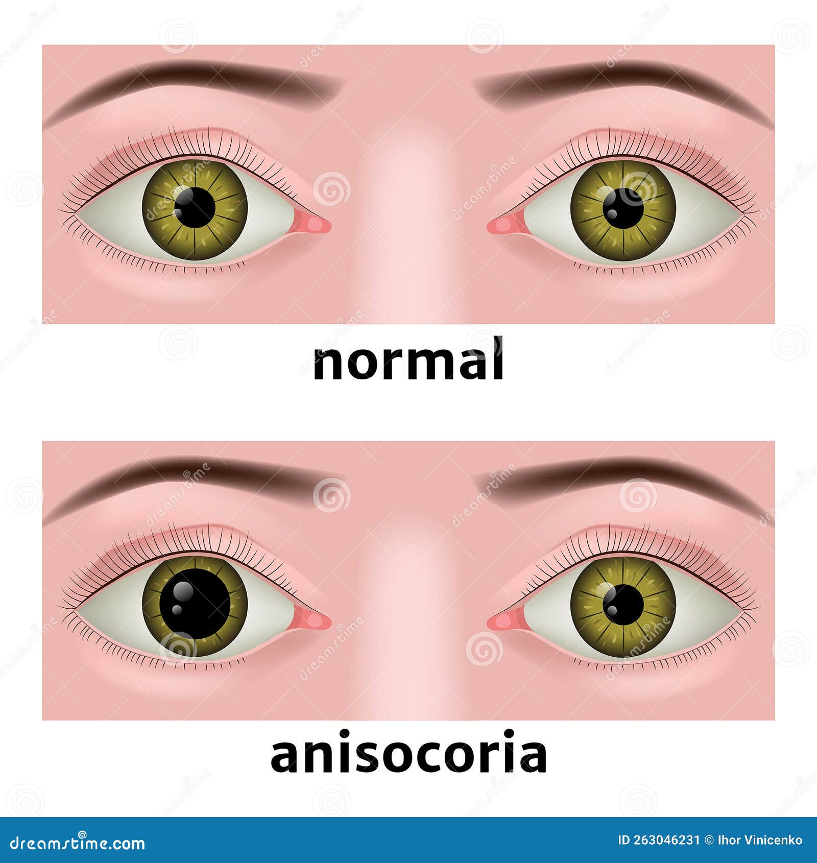 Anisocoria. Abnormally Dilated Pupil of the Eye Stock Vector ...