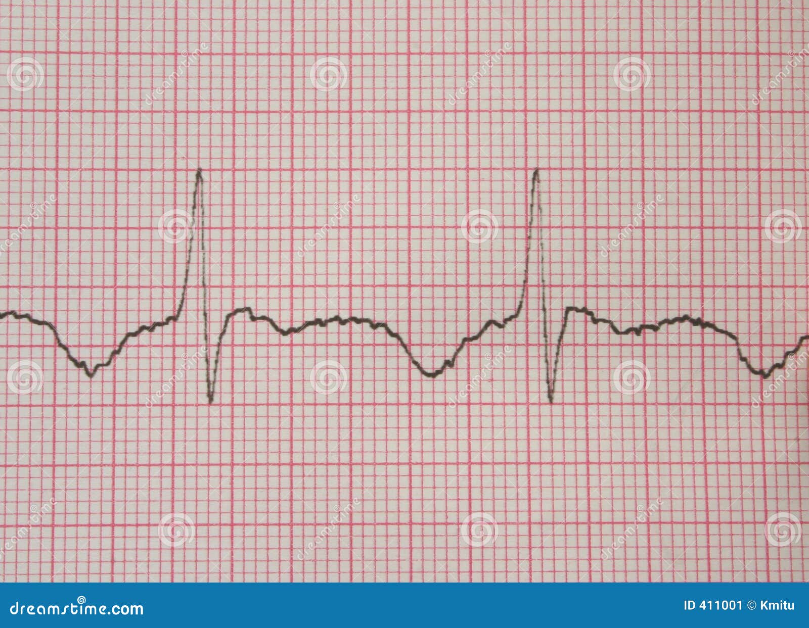2 ecg 库存图片. 图片 包括有 心伤, 考试, 诊所, 心脏病学, 核对, 医疗, 分析, 图表, 诊断 - 411001