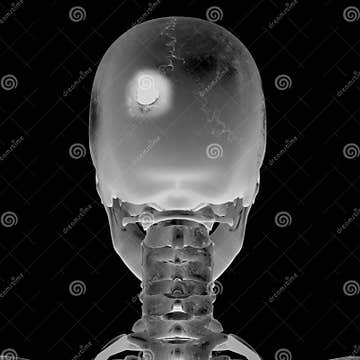 3D Radiograph with Head Injury Stock Illustration - Illustration of ...