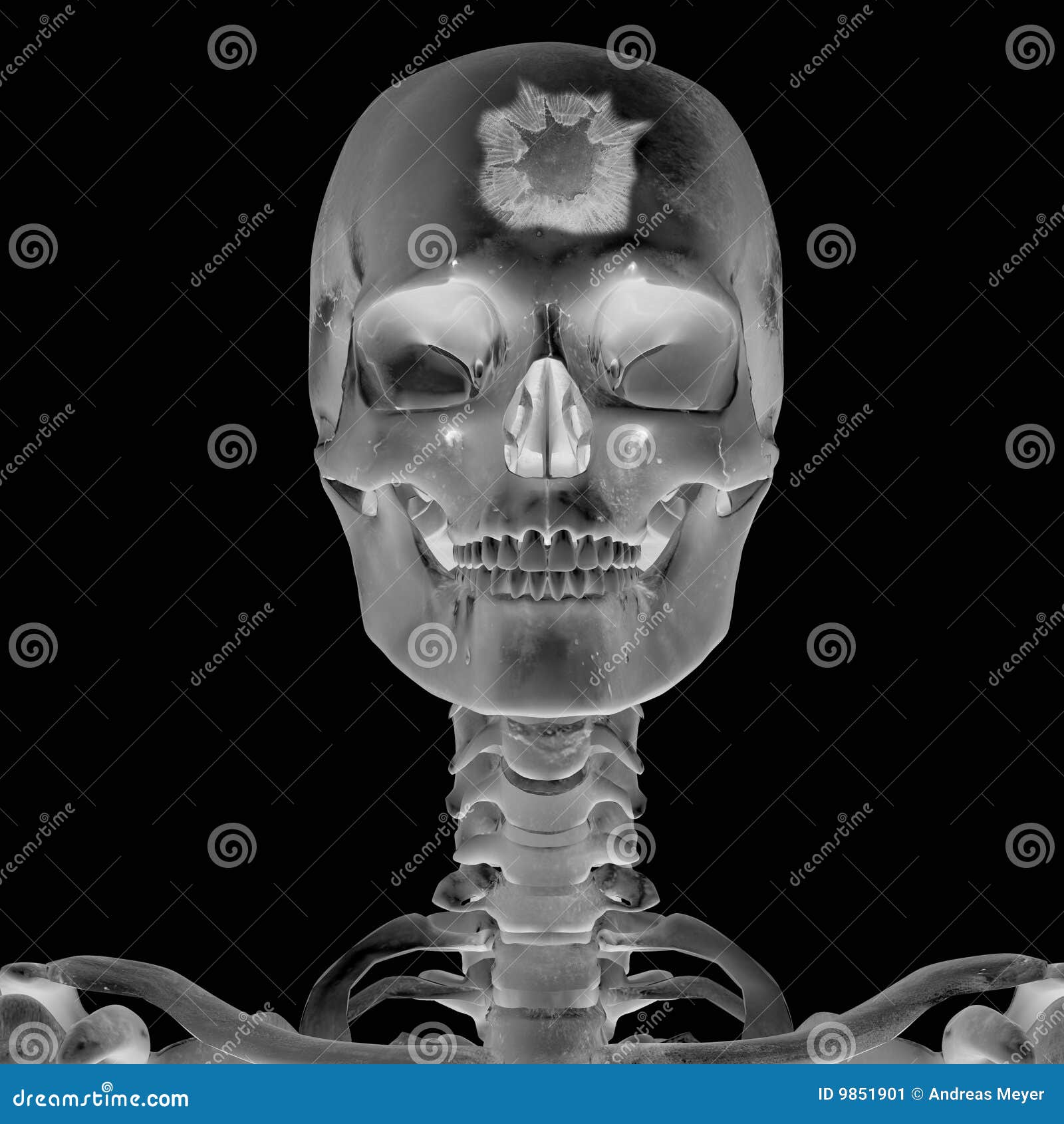 3D Radiograph with Head Injury Stock Illustration - Illustration of ...