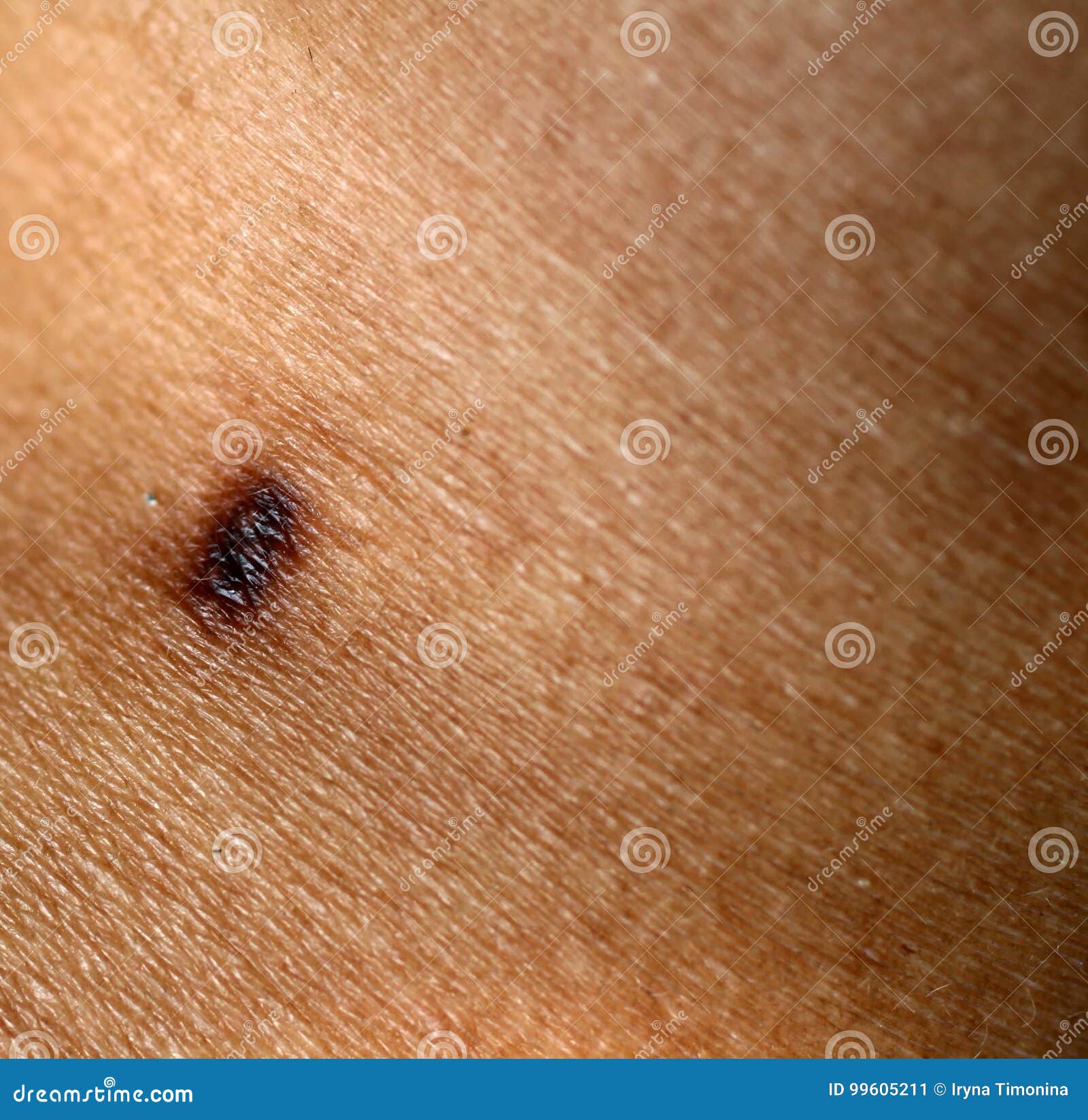 Abbau Eines Muttermals Mit Einem Laser Brown-Spur Vom Muttermal Auf ...