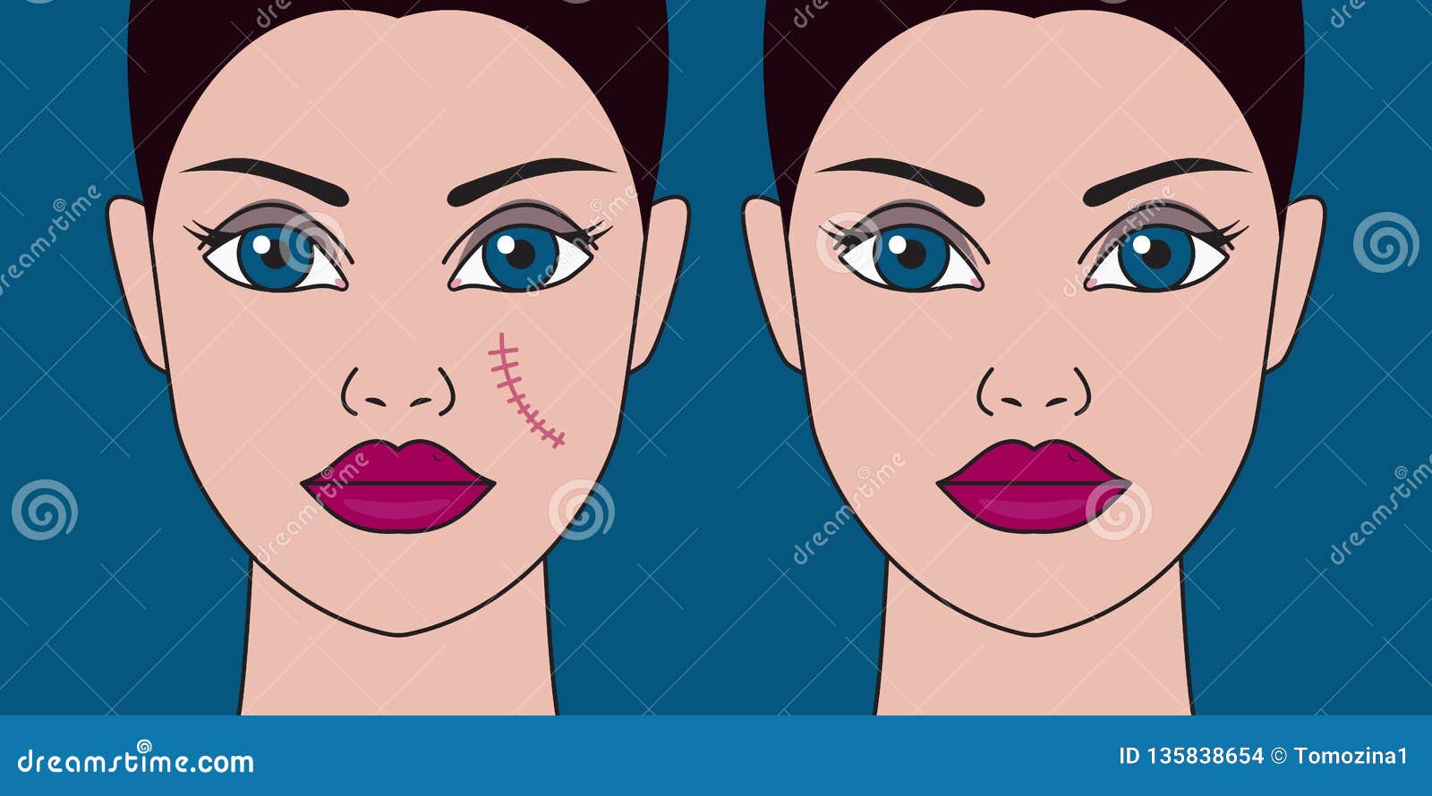 Abbau Von Narben Vom Gesicht Vektor Abbildung - Illustration von ...