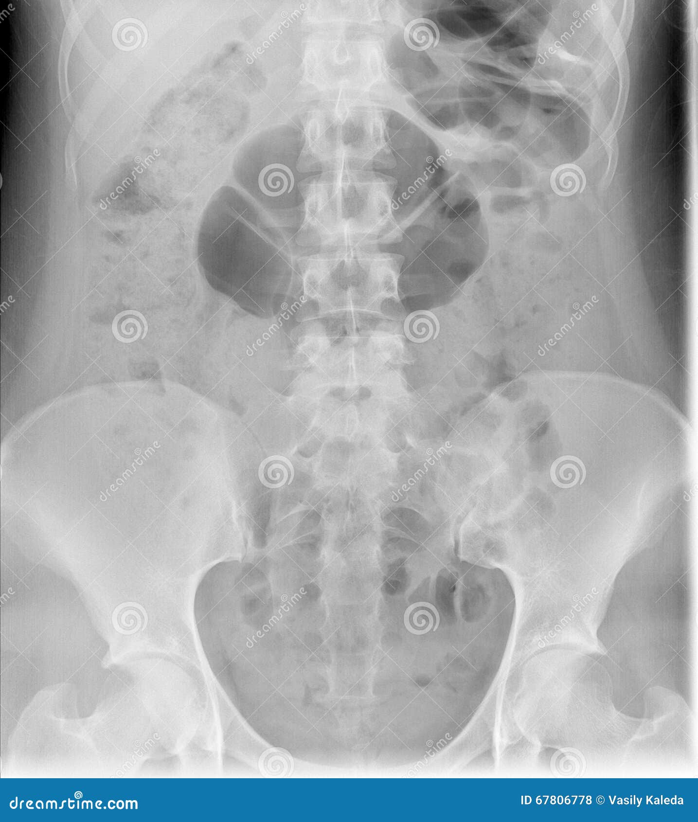 Abdomen on Roentgenogram stock photo. Image of roentgen - 67806778