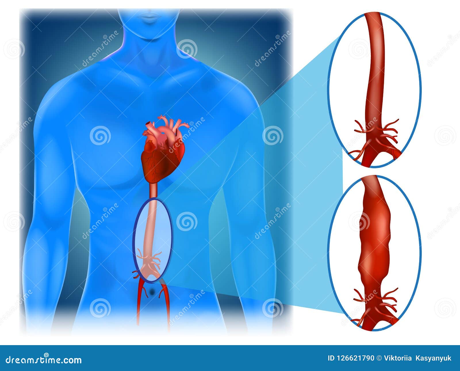 Abdominal aortic aneurysm stock vector. Illustration of biology - 126621790