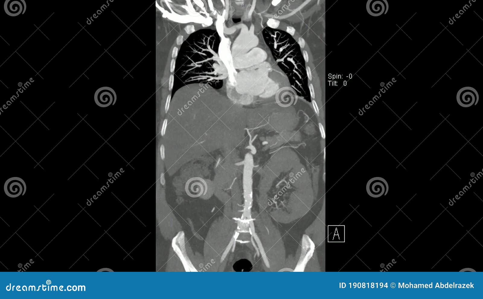 Abdominal Aortogram CT Coronal Plane Stock Footage - Video of aortogram ...