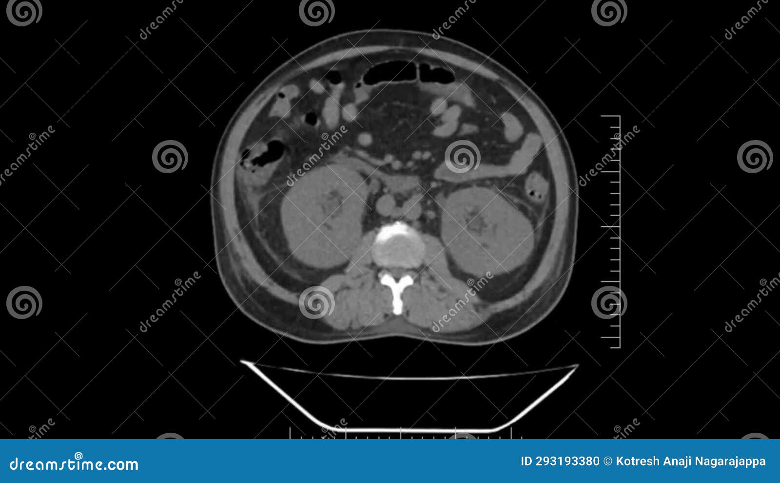Abdominal CT Scan or Abdomen Mri Stock Footage - Video of anatomy ...