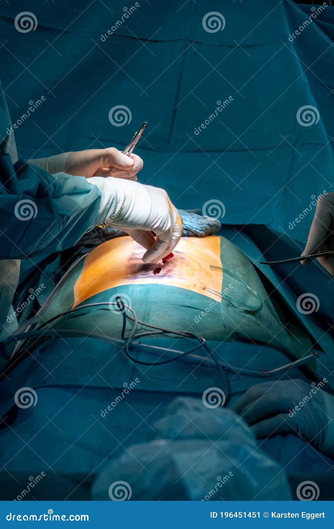 Abdominal Operation is Performed in an Operating Room Stock Image ...