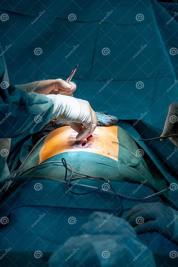 Abdominal Operation is Performed in an Operating Room Stock Image ...