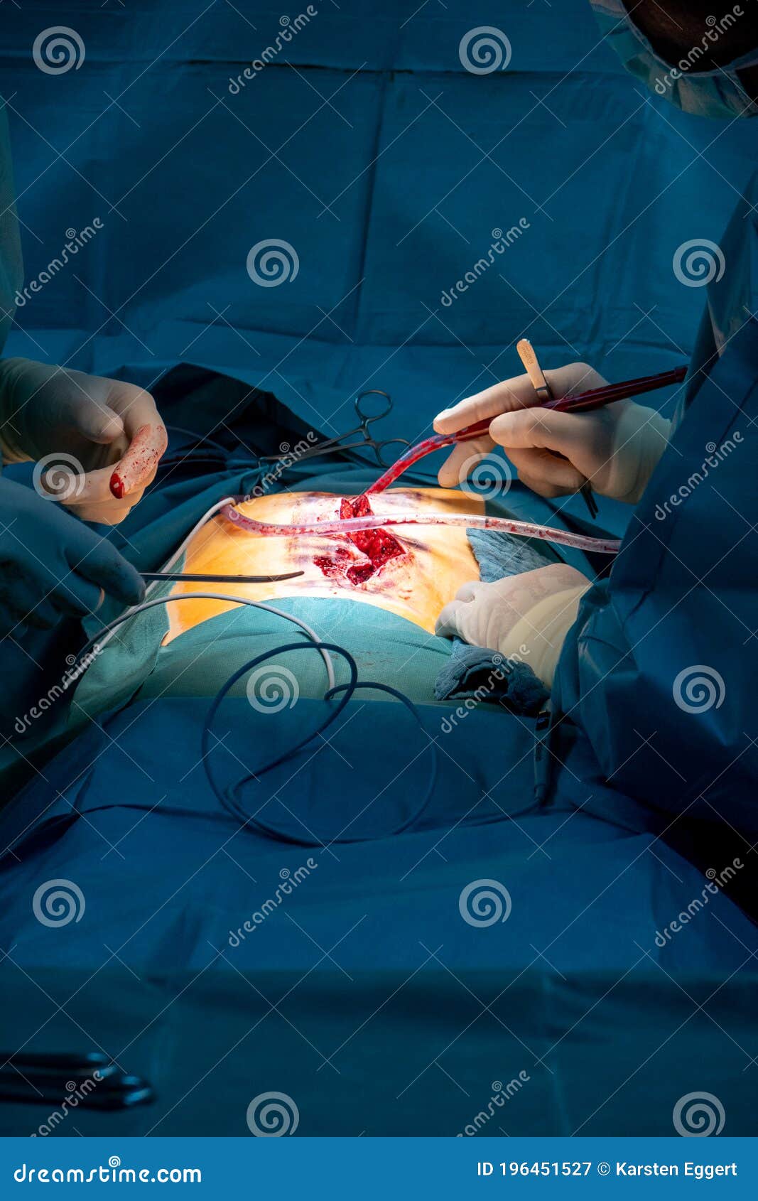 Abdominal Operation is Performed in an Operating Room Stock Image ...