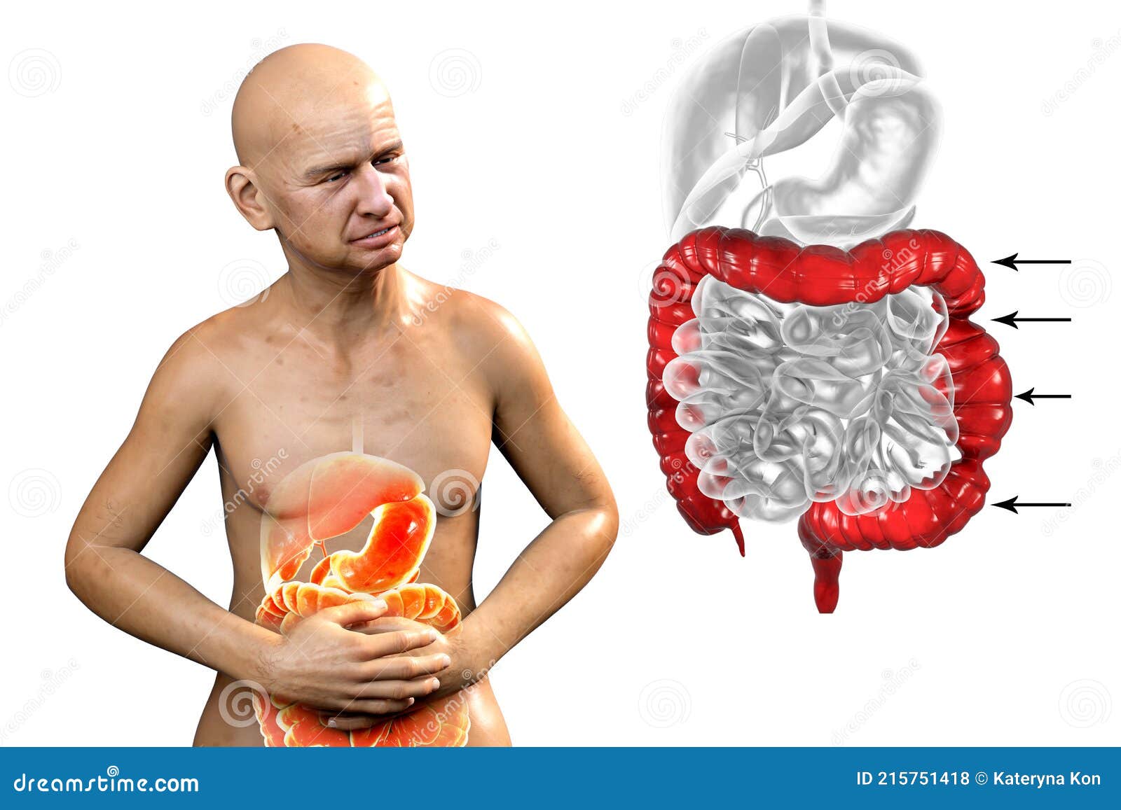 Serotonin Syndrome Vector Illustration With Medical Labeled Symptoms ... Serotonin Syndrome Vector Illustration With Medical Labeled Symptoms ...